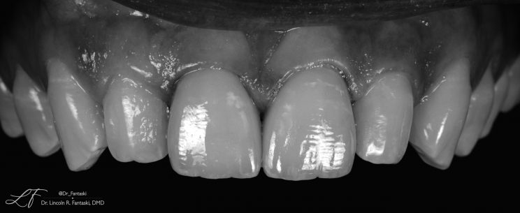 Front Teeth Crowns: Matching (or beating) Nature | Dr. Fantaski