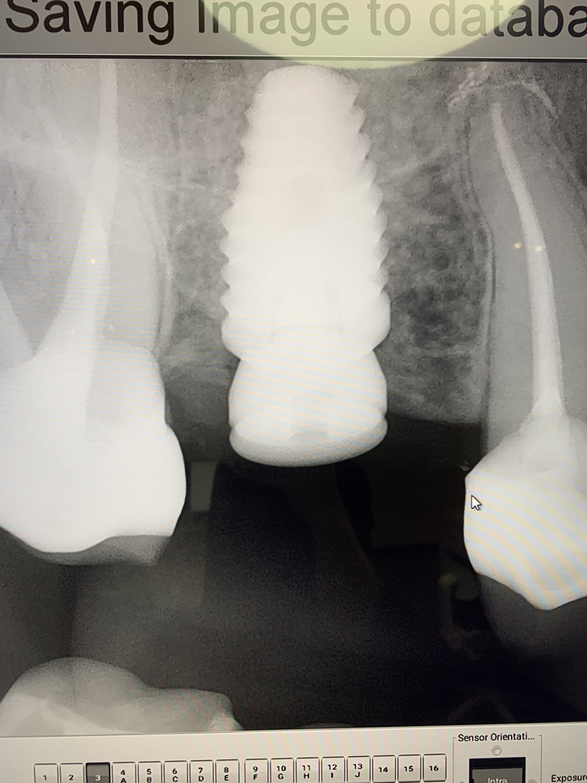 Guided Surgery for Implants | Dr. Fantaski