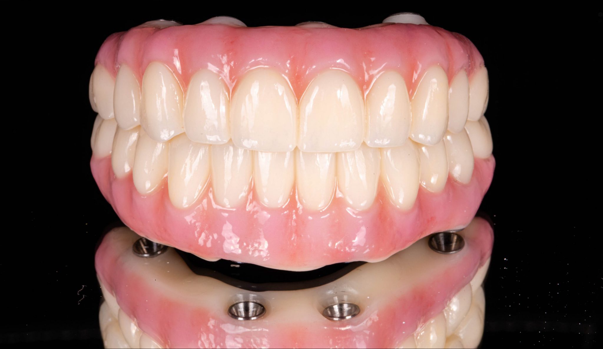 Full Arch Hybrids - All On X - @FantaskiSmiles