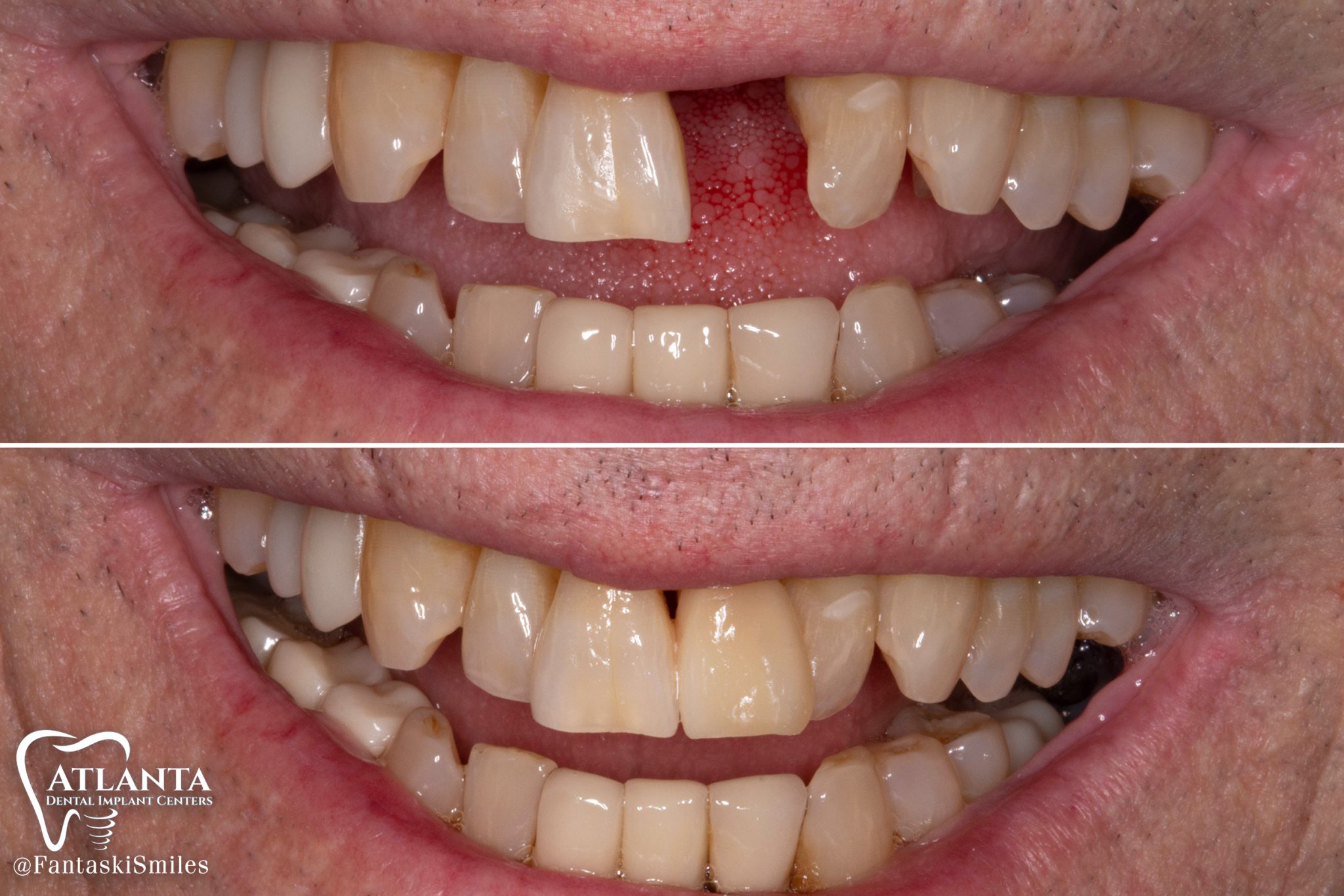 Single Front Tooth Implant – @FantaskiSmiles