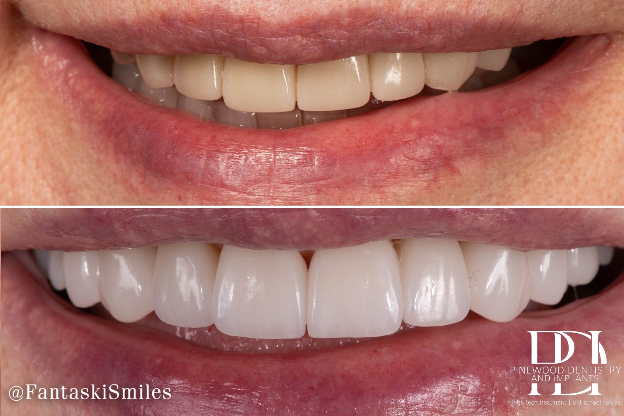 Layered eMax Crowns – Smile Refresh – @FantaskiSmiles